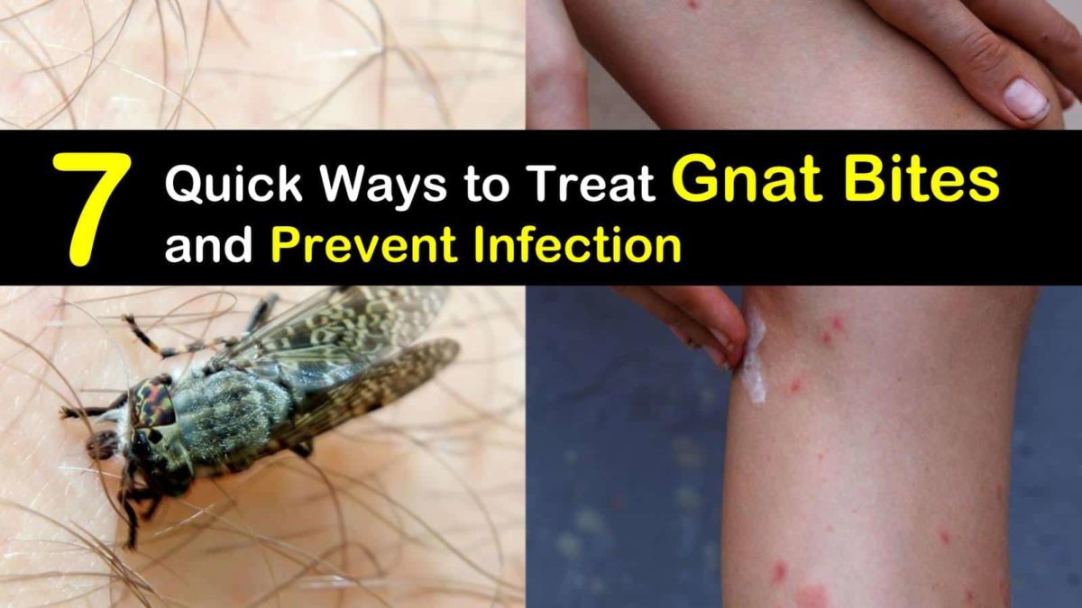 7 Quick Ways to Treat Gnat Bites and Prevent Infection